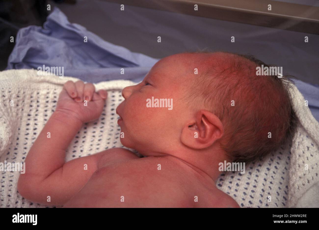 Deformed Baby Stockfotos und -bilder Kaufen - Alamy