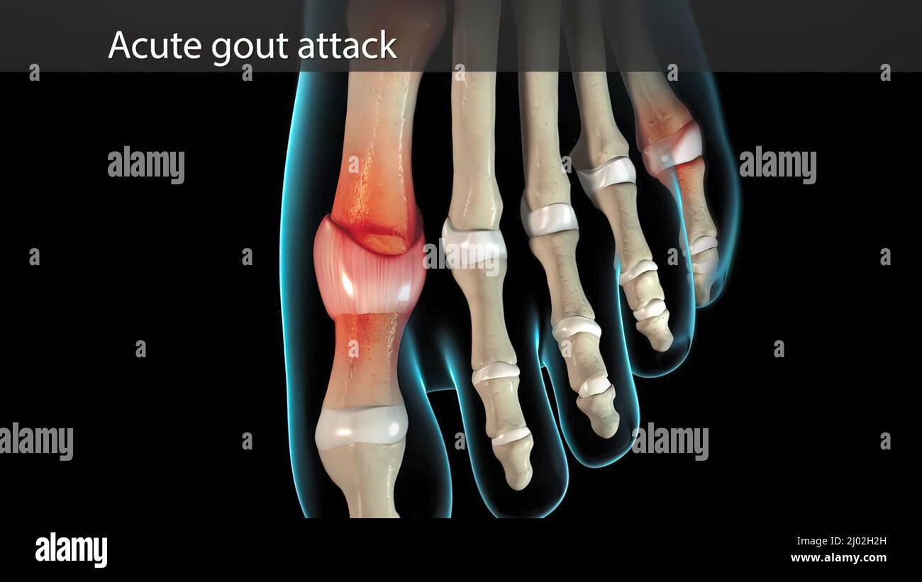 Hallux Valgus Illustration Stockfotos und -bilder Kaufen - Alamy
