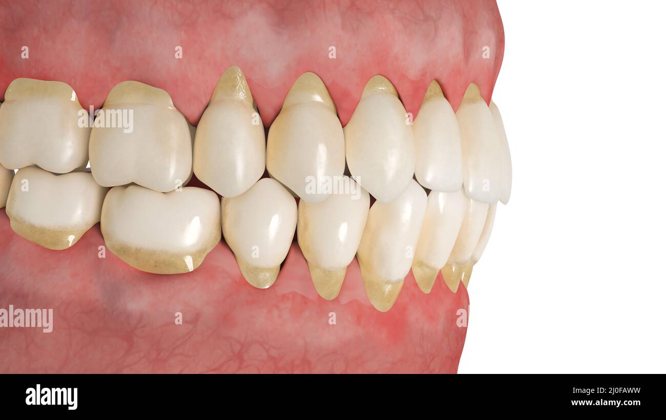 Zahn parodontitis illustration -Fotos und -Bildmaterial in hoher ...