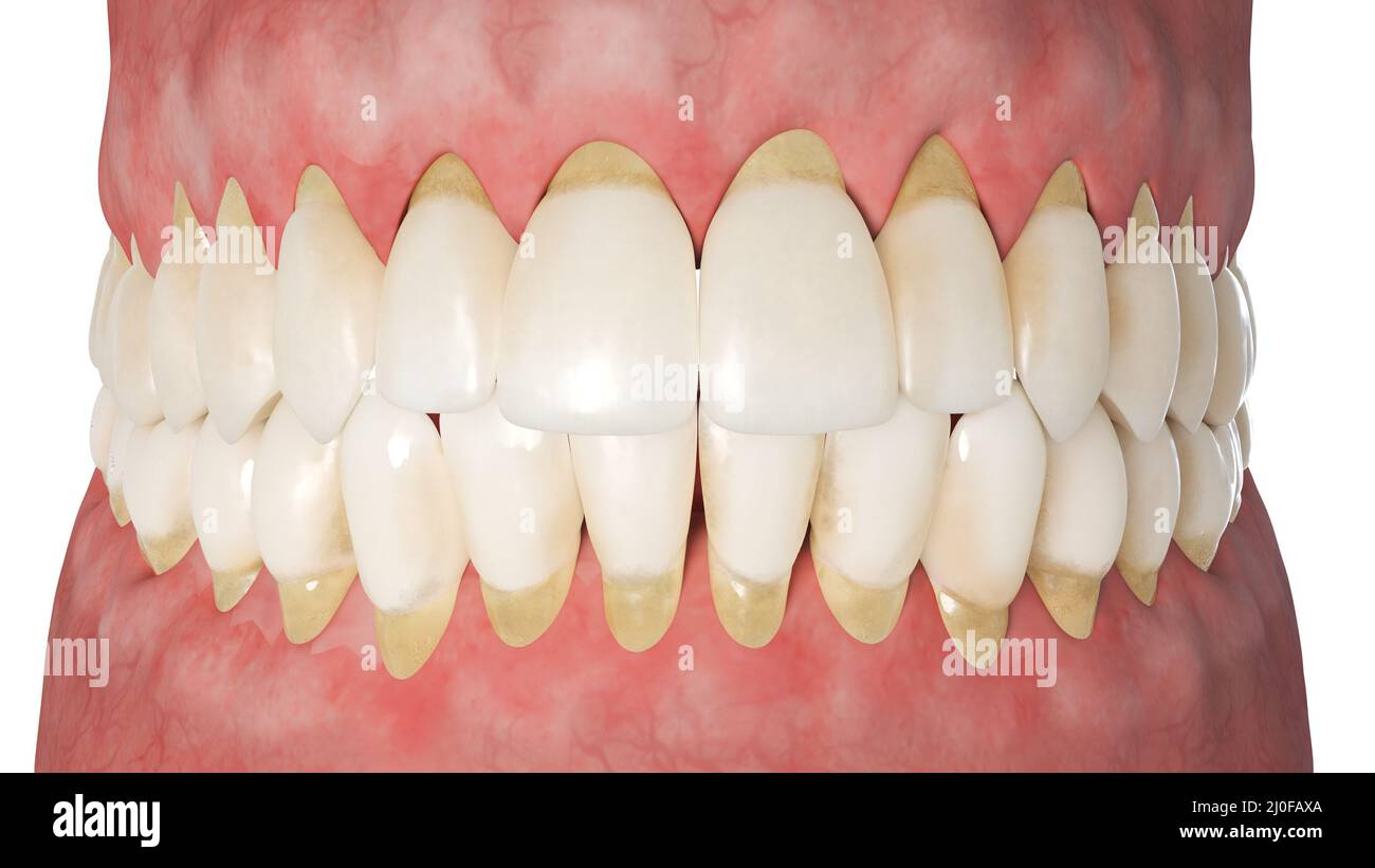 Zahn parodontitis -Fotos und -Bildmaterial in hoher Auflösung – Alamy