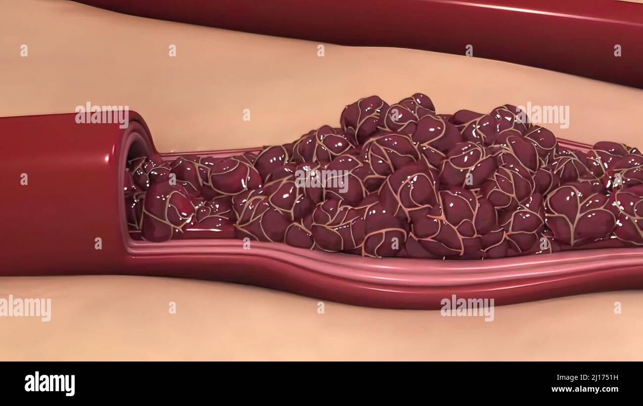 Ein Aneurysma des Gehirns ist eine Beule oder Ballonfahrt in einem ...