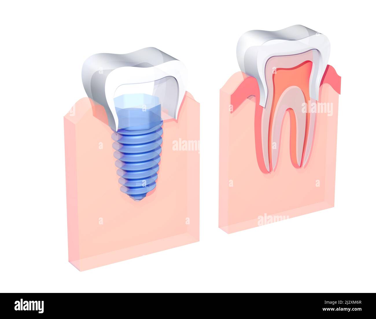 3D Darstellung eines Zahnimplantats in einem Zahnfleisch, neben einem ...