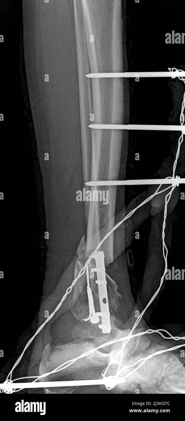 Tibial fracture -Fotos und -Bildmaterial in hoher Auflösung – Alamy
