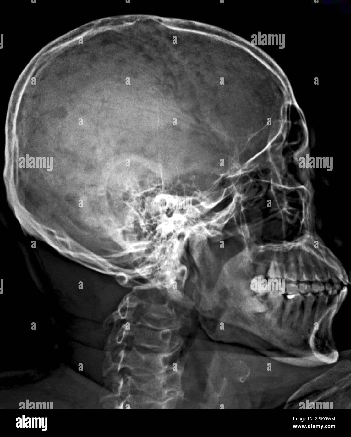 Multiple myeloma diagnosis -Fotos und -Bildmaterial in hoher Auflösung ...