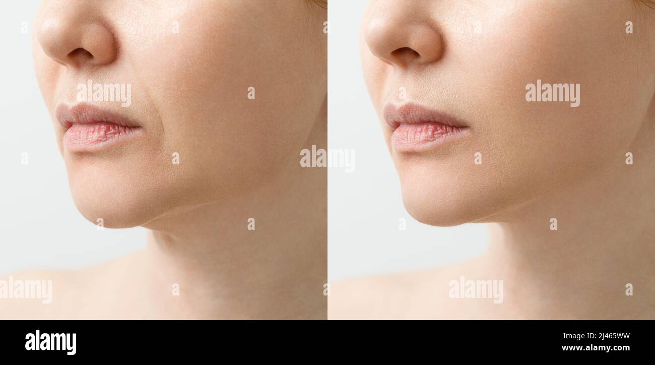 Ein Porträt einer gealterten Frau vor und nach der Gesichtsverjüngung ...
