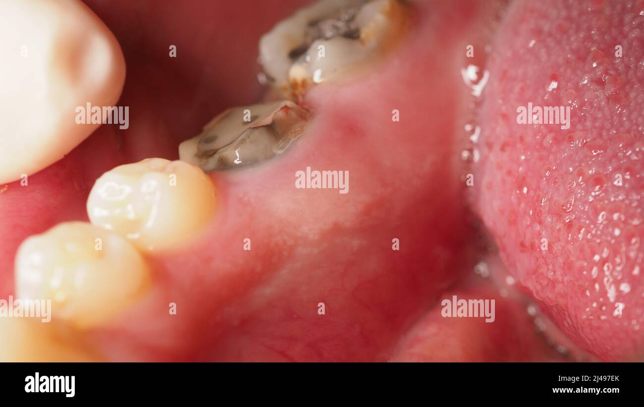 Tooth decay -Fotos und -Bildmaterial in hoher Auflösung – Alamy