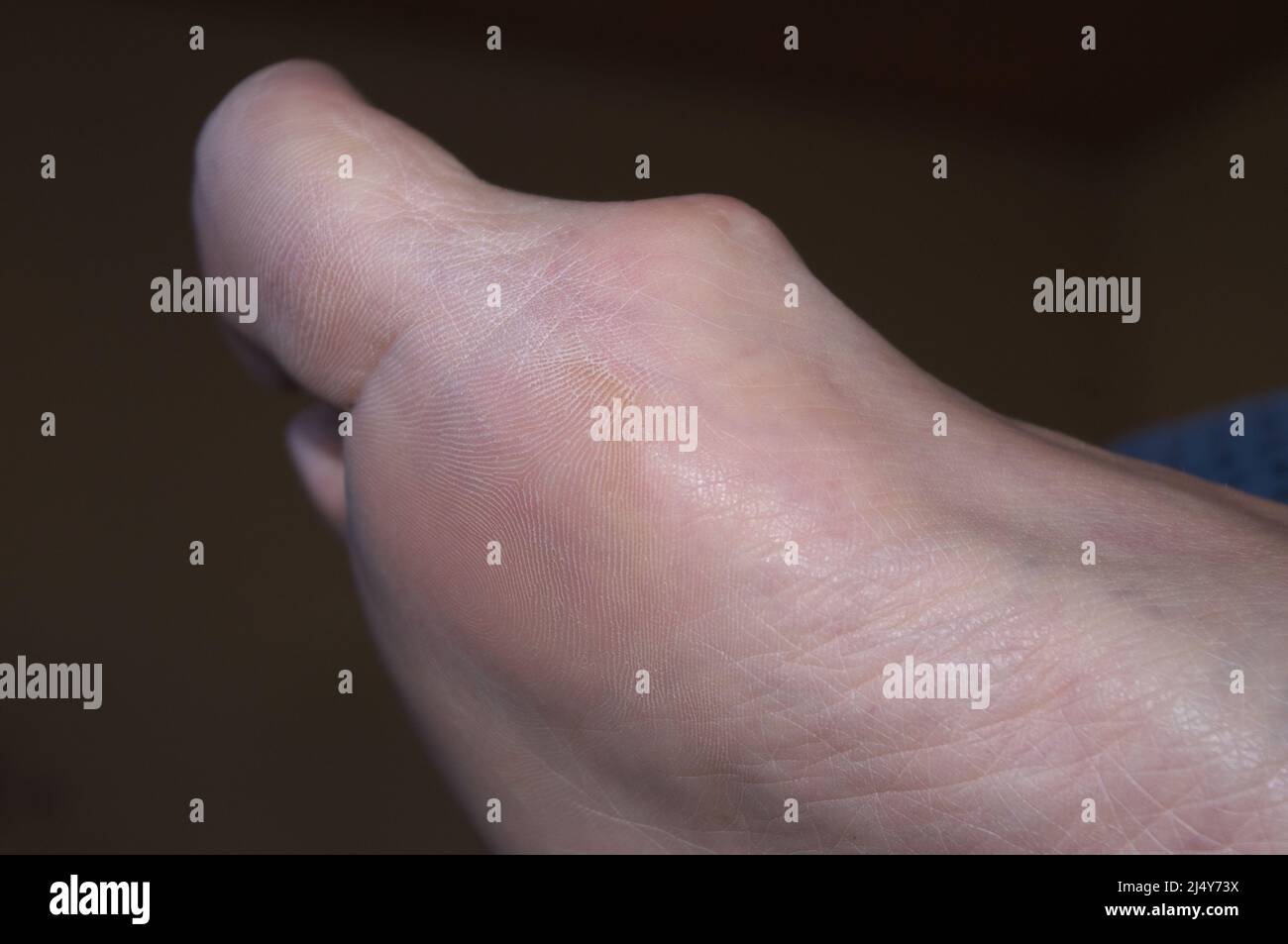 Hallux valgus -Fotos und -Bildmaterial in hoher Auflösung – Alamy