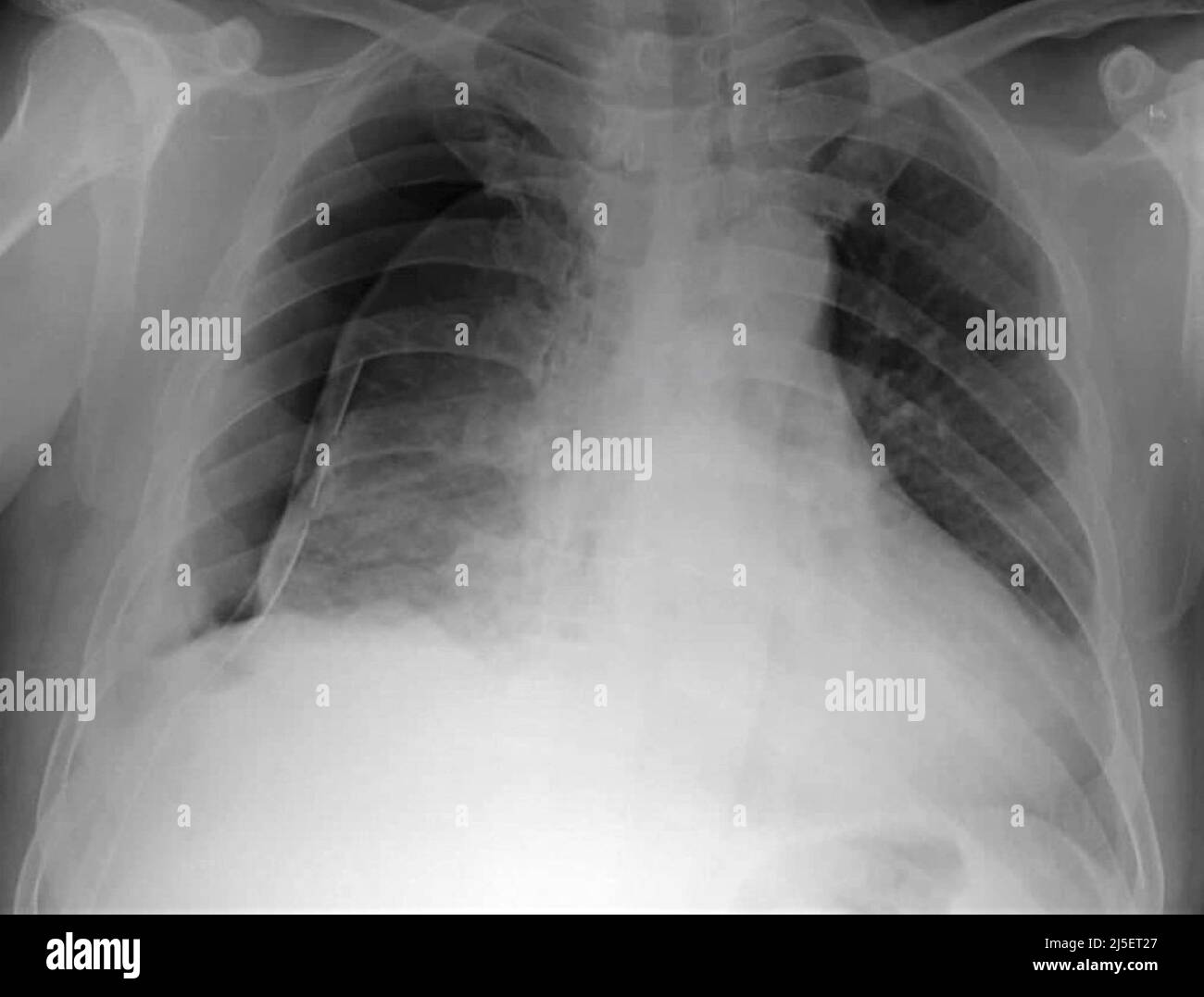 Thorax röntgen -Fotos und -Bildmaterial in hoher Auflösung – Alamy