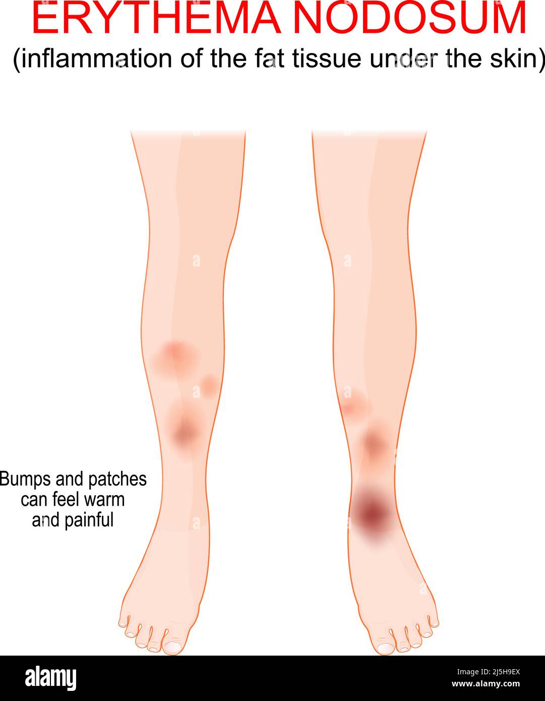 Erythema Nodosum Zeitraum | Erythema Nodosum Leitlinie – RUAUE