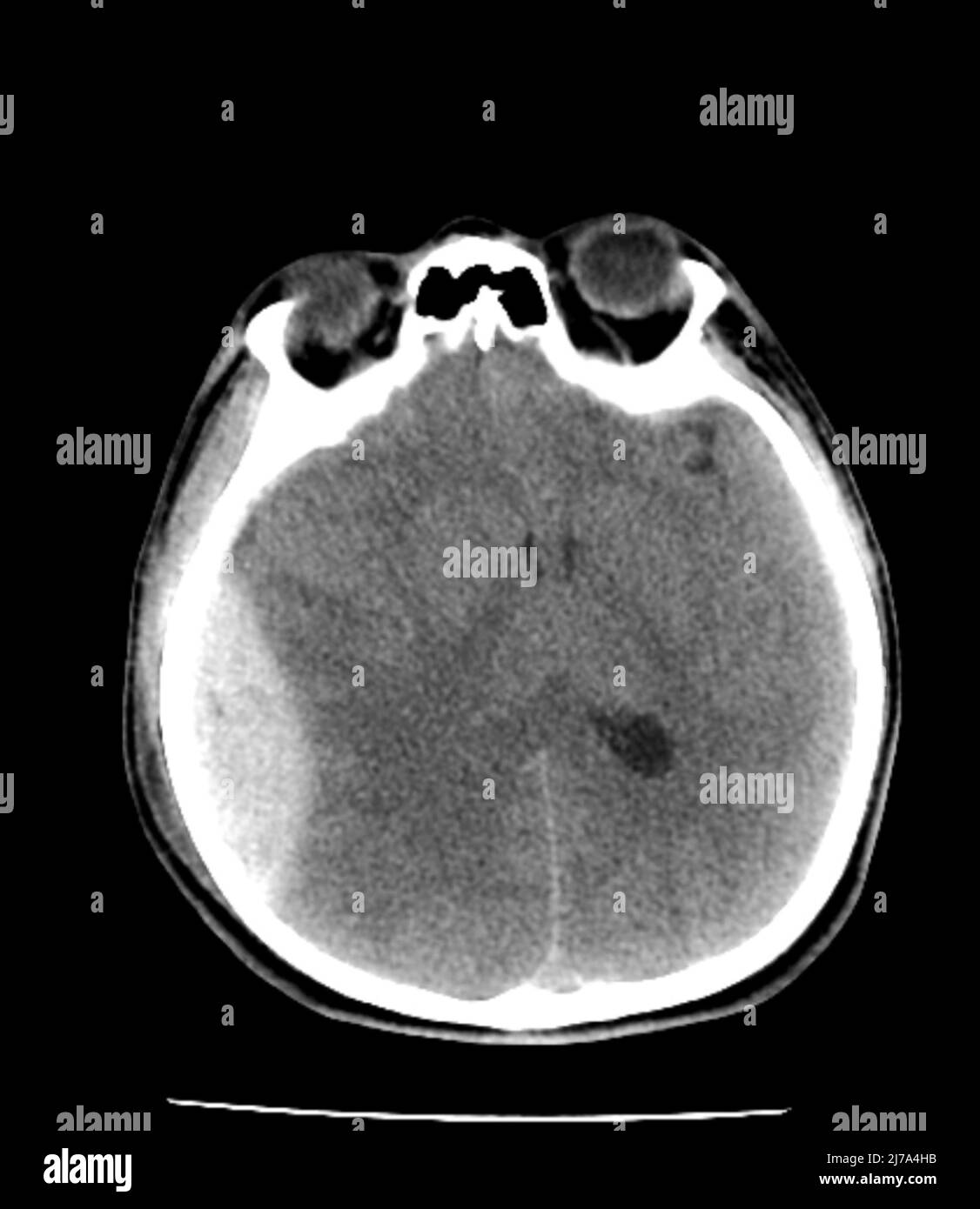 Ct scan head injury -Fotos und -Bildmaterial in hoher Auflösung – Alamy