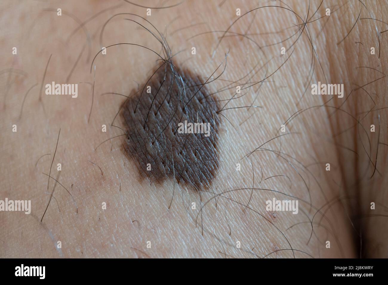 Gutartiger hauttumor -Fotos und -Bildmaterial in hoher Auflösung – Alamy