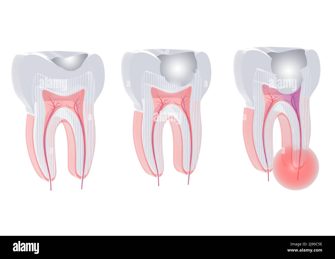 Dentin karies Ausgeschnittene Stockfotos und -bilder - Alamy