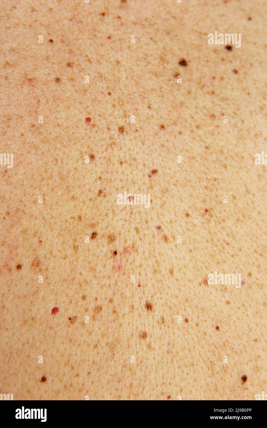 Muttermale und Muttermale auf menschlicher Hautstruktur. Foto vertikal ...