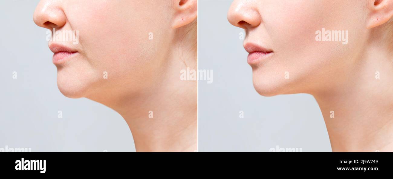 Weibliches Doppelkinn vor und nach der Korrektur. Korrektur der Kinn ...
