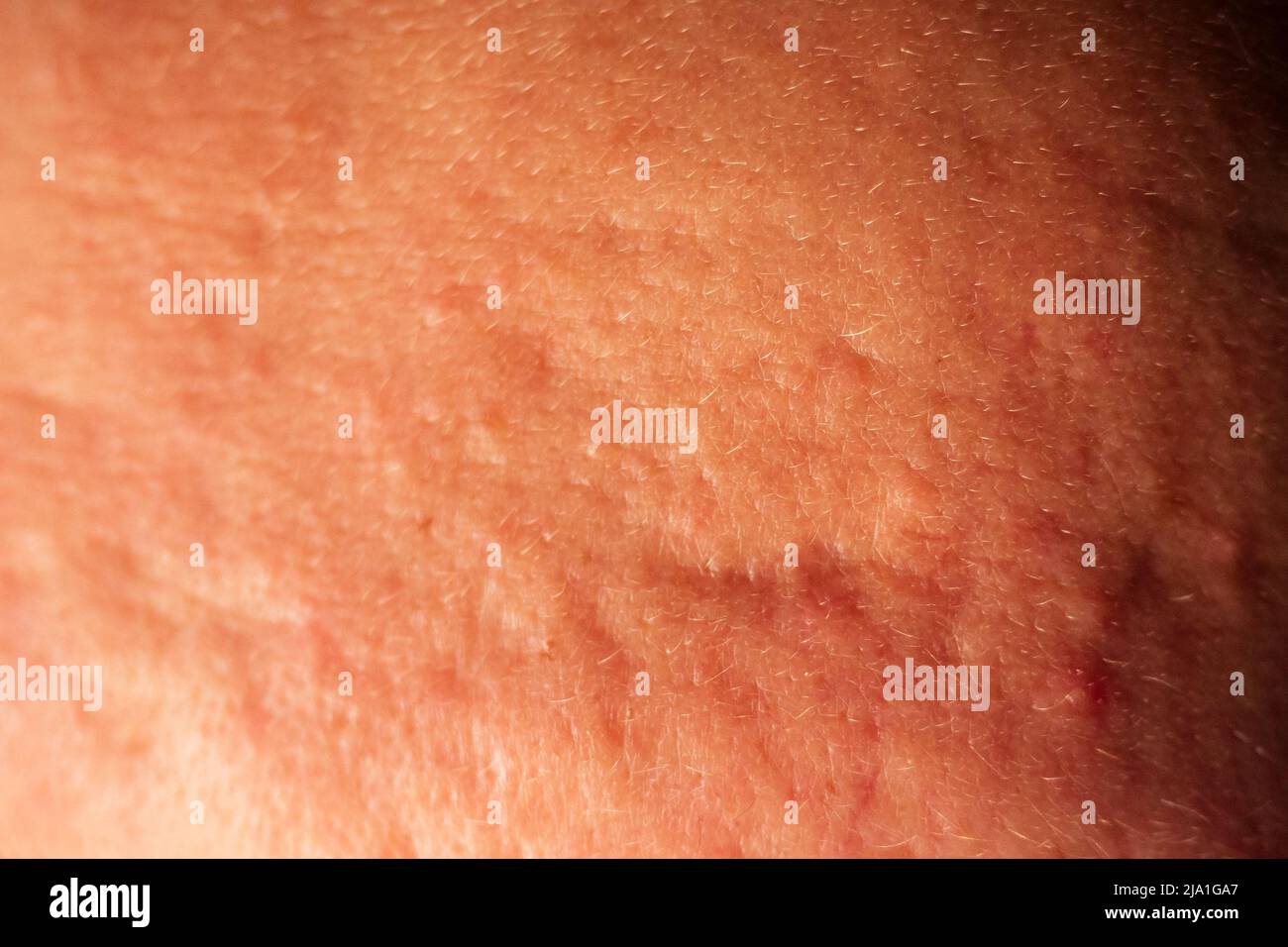 Rote flecken auf haut -Fotos und -Bildmaterial in hoher Auflösung – Alamy