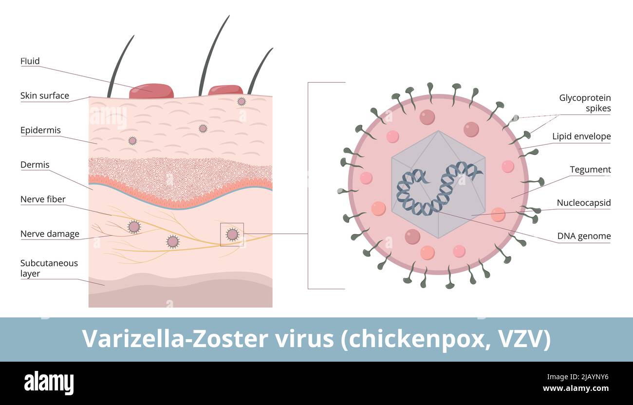 Varicella-Zoster-Virus (Windpocken, VZV). Detailliertes Schema von ...