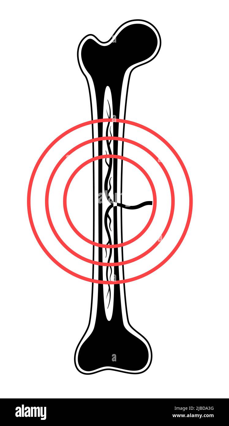 Knochenaufbau system -Fotos und -Bildmaterial in hoher Auflösung – Alamy