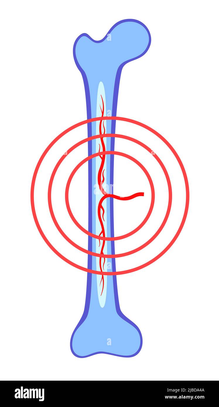 Ossification of the femur Ausgeschnittene Stockfotos und -bilder - Alamy