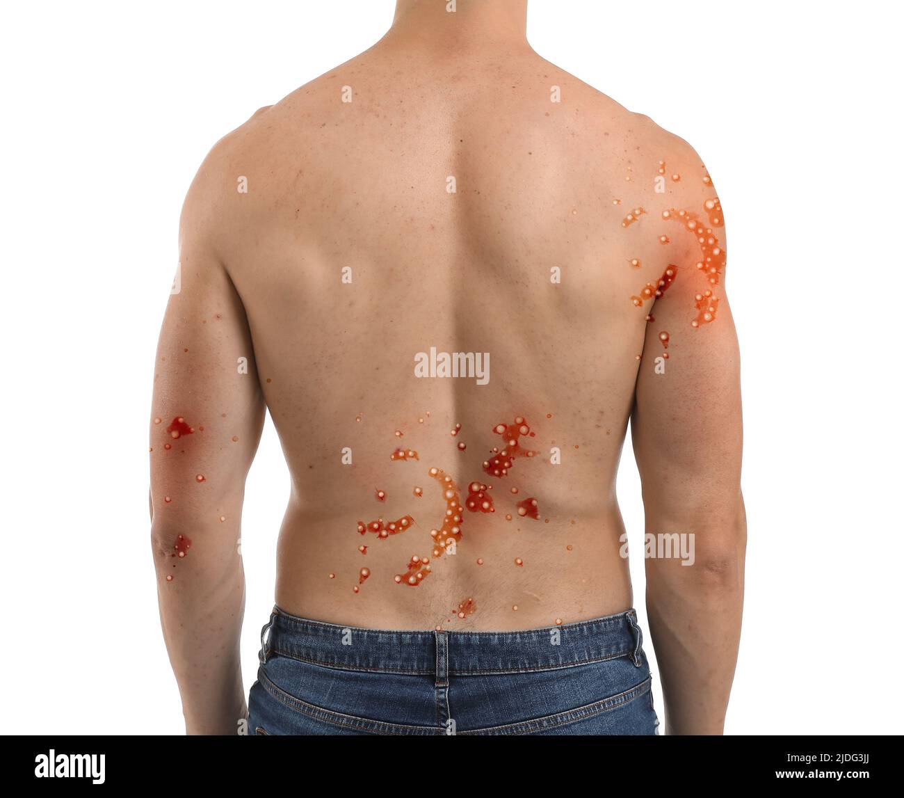 Pickel beulen -Fotos und -Bildmaterial in hoher Auflösung – Alamy