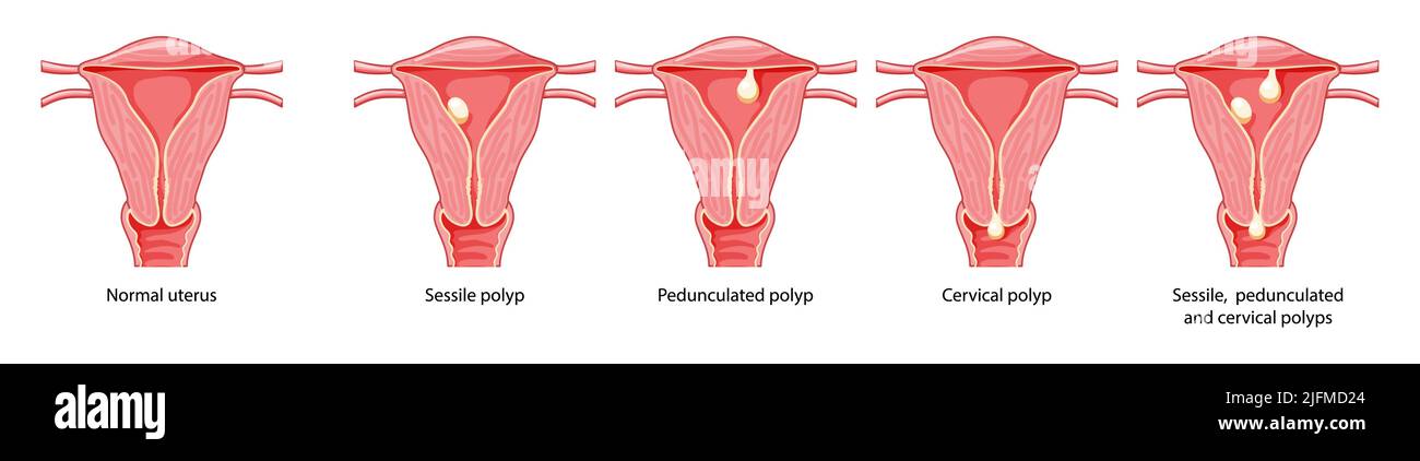 Satz von Polypen in der Gebärmutter Weibliches Fortpflanzungssystem in Querschnitten Krankheiten ...