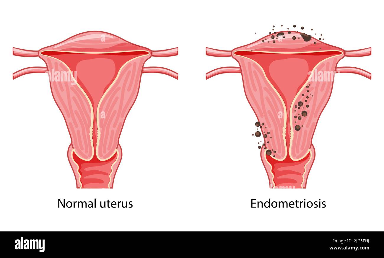 Endometriose Stadien Weibliches Fortpflanzungssystem normal und mit Krankheit Schmerzen ...