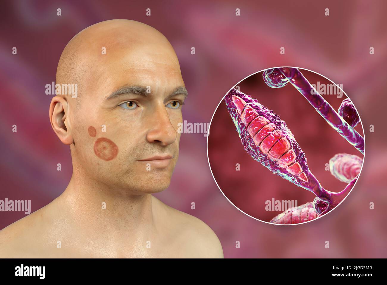 Dermatophytose pilzerkrankung haut dermatologie pilzpilze tinea ...