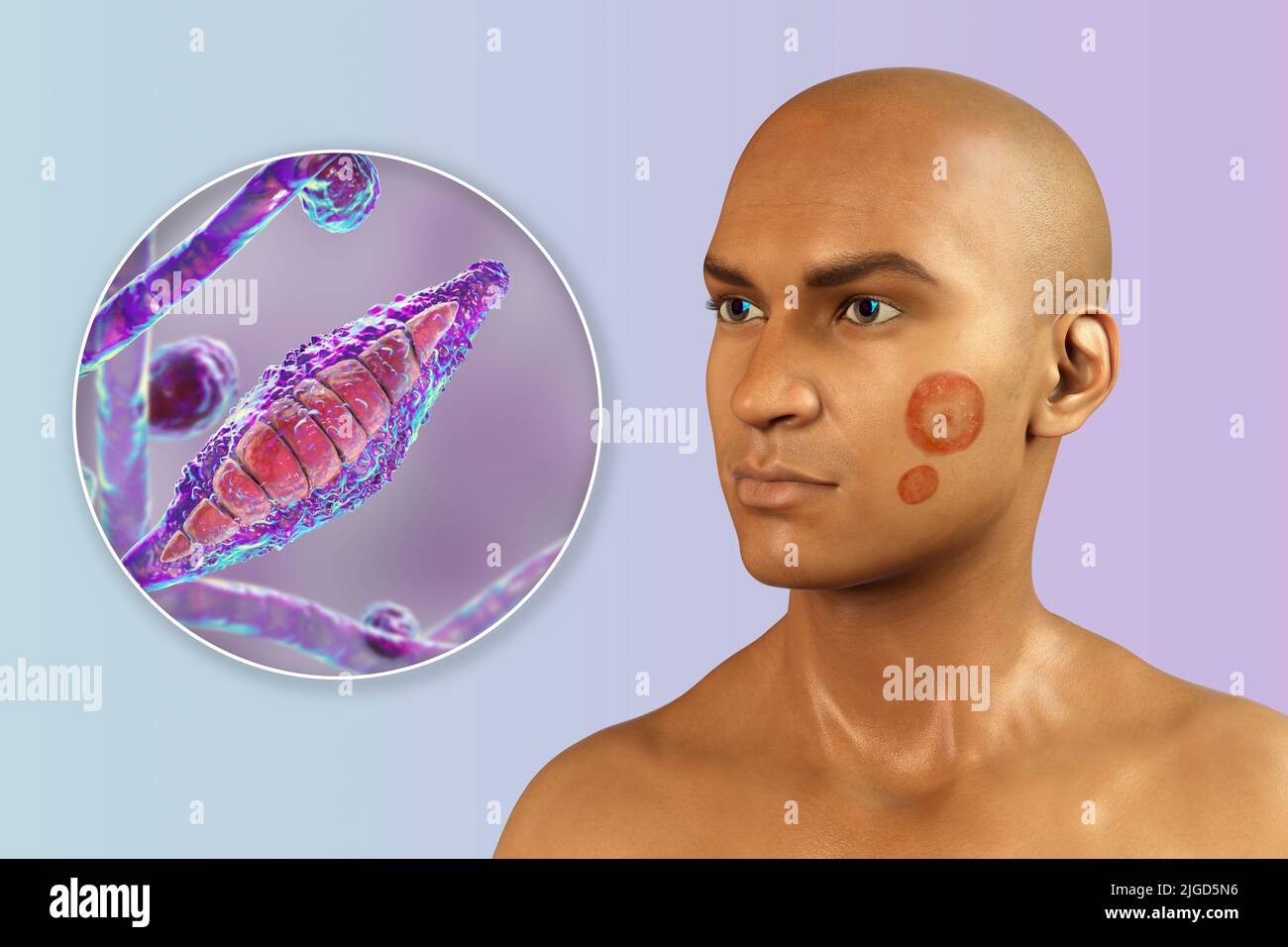 Dermatophytosis ringworm -Fotos und -Bildmaterial in hoher Auflösung ...