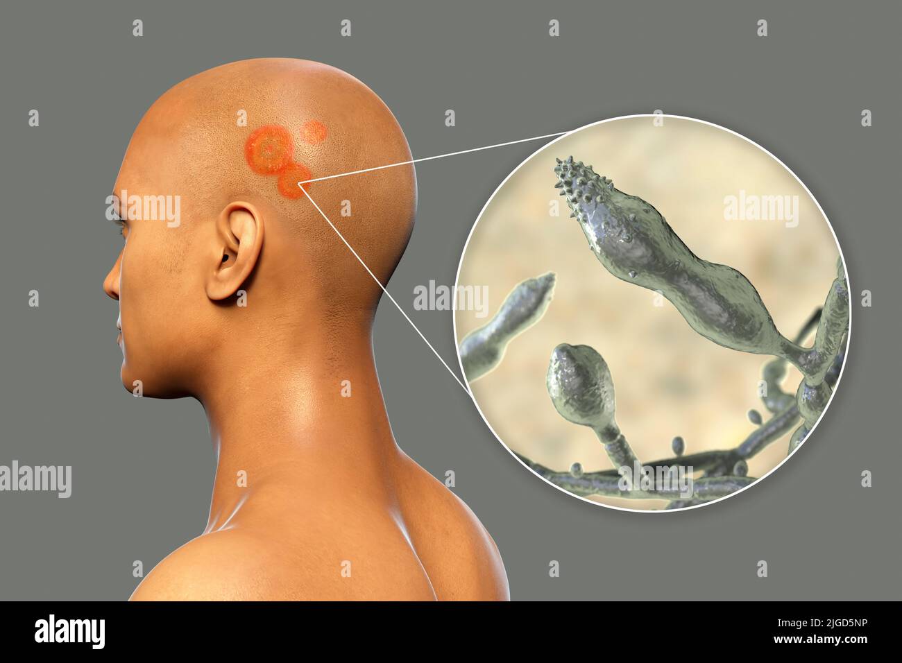 Dermatophytosis fungal condition skin dermatology fungus fungi tinea ...