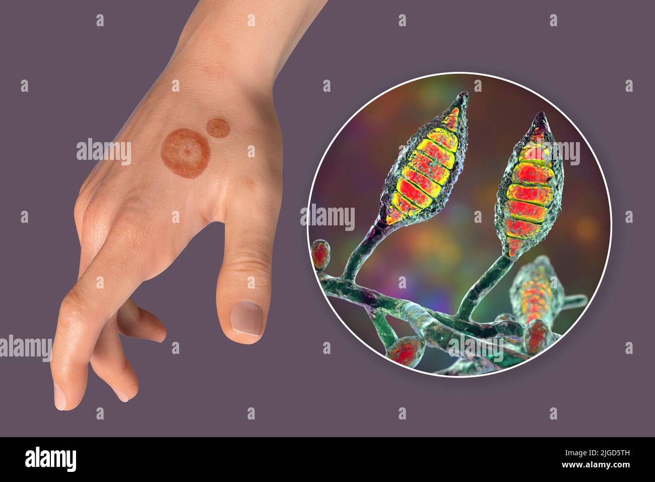 Hautausschlag ringelflechte -Fotos und -Bildmaterial in hoher Auflösung ...