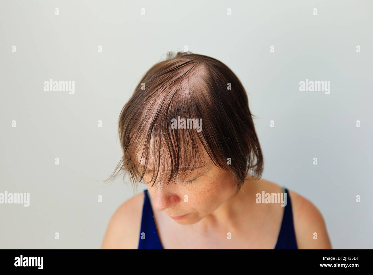 Diffuser haarausfall -Fotos und -Bildmaterial in hoher Auflösung – Alamy