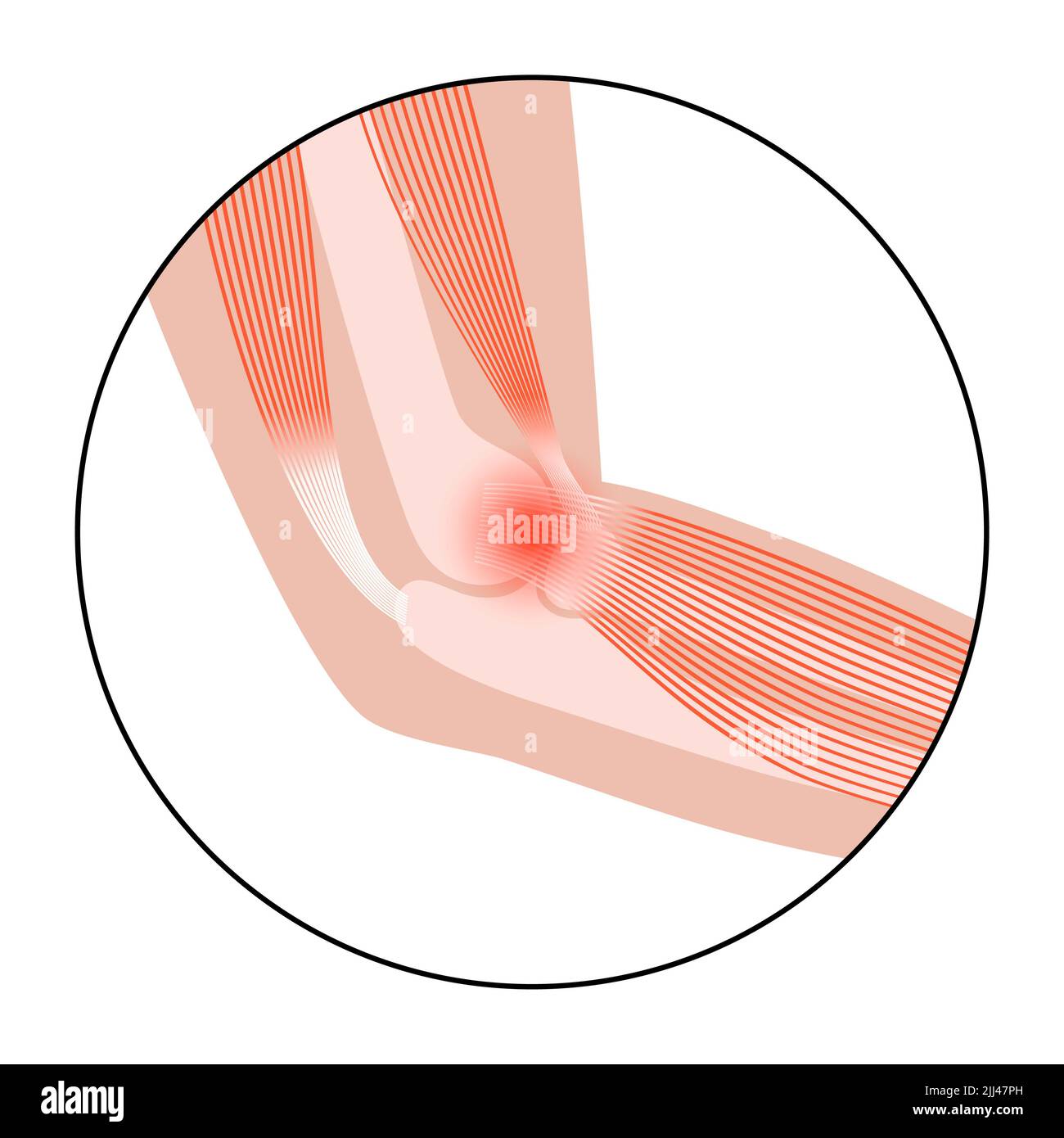 Epicondylitis lateralis Ausgeschnittene Stockfotos und -bilder - Alamy