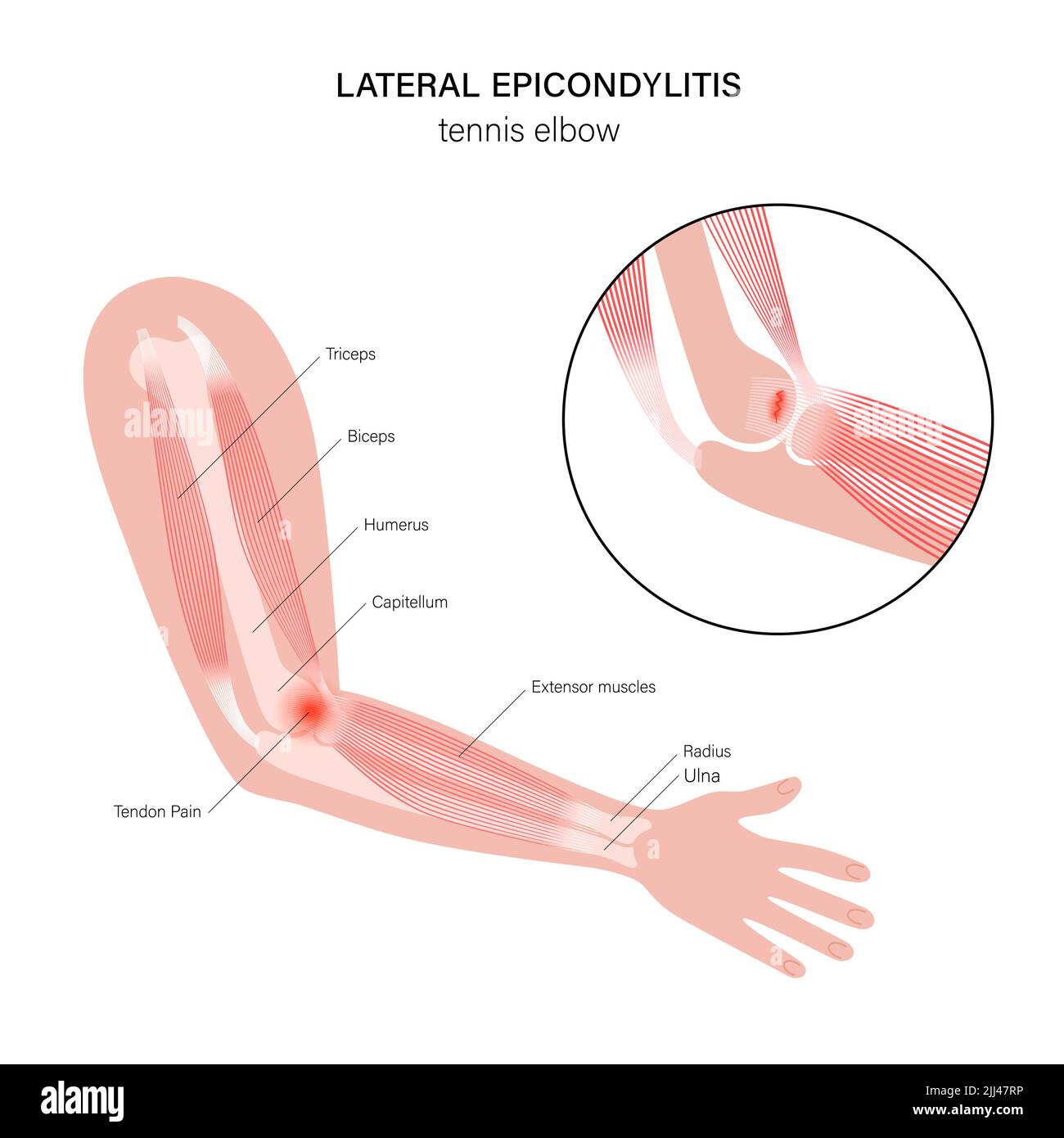 Epicondylitis lateralis Ausgeschnittene Stockfotos und -bilder - Alamy