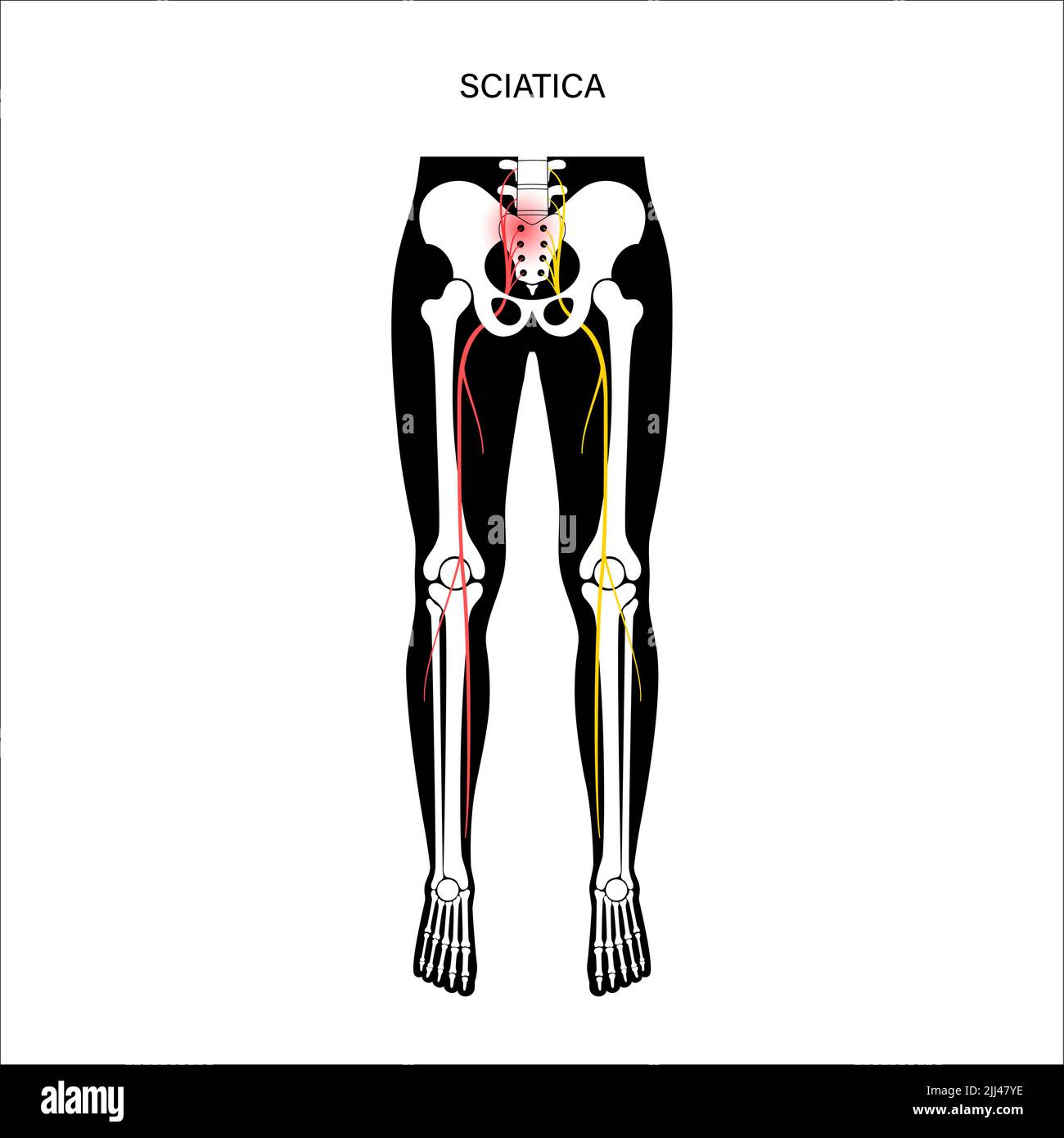 Ischias plexus -Fotos und -Bildmaterial in hoher Auflösung – Alamy