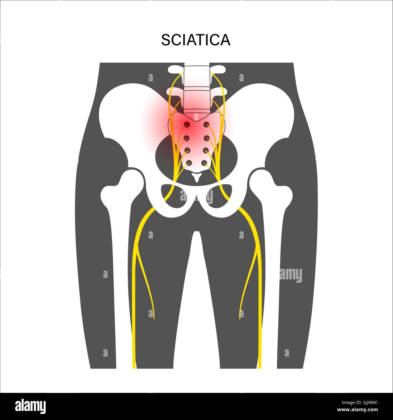 Spinal stenosis illustration -Fotos und -Bildmaterial in hoher ...