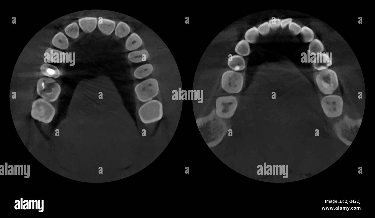 Zähne, realistischer 3D Scan Kiefer, dentale MRT mit Karies ...