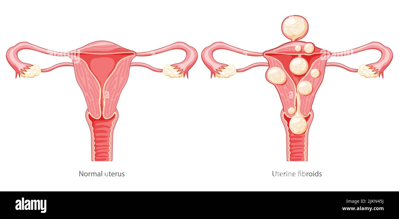 Satz von Uterusmyomen Weibliche Leiomyome Fortpflanzungssystem Uterus normal und mit ...