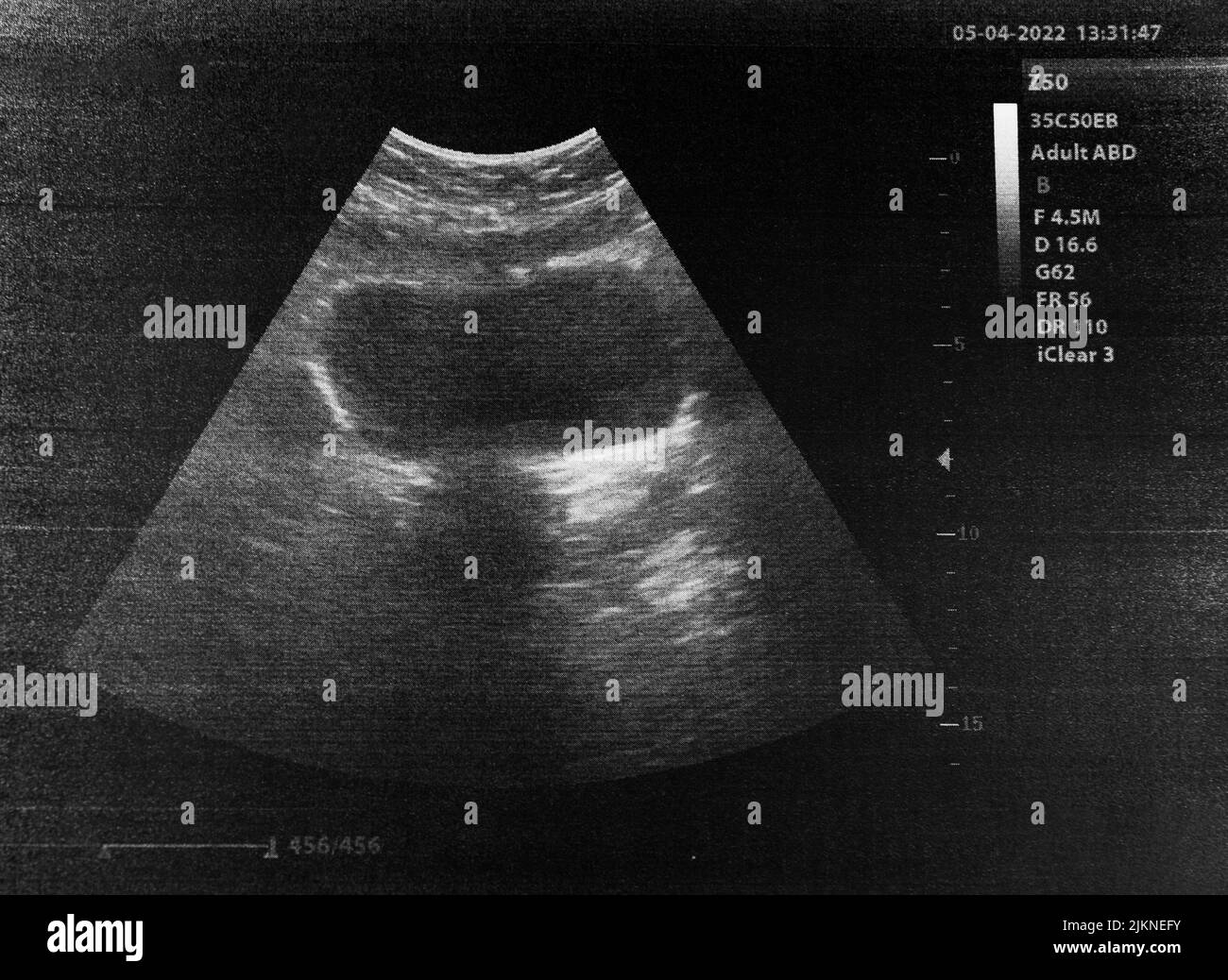 Leber ultraschall -Fotos und -Bildmaterial in hoher Auflösung – Alamy