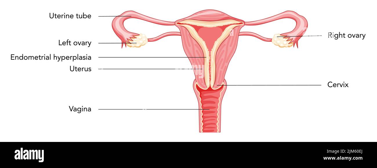 Endometrialhyperplasie Weibliches Fortpflanzungssystem Uterus in verschiedenen Stilen Diagramm ...