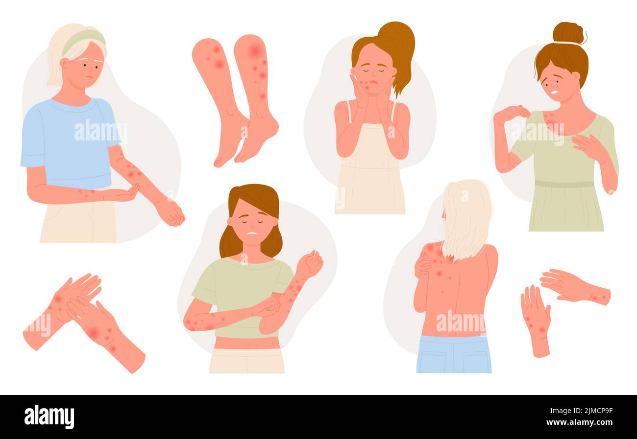 Allergie auf der Haut des Körpers, medizinische Infografik flache ...