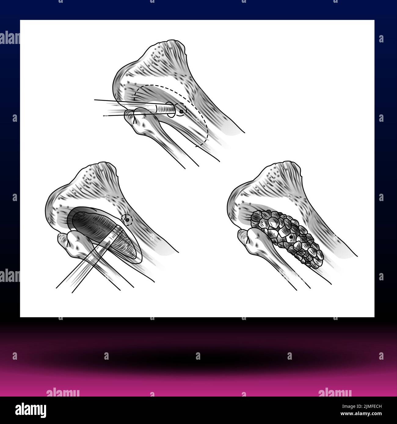 Fibulafraktur -Fotos und -Bildmaterial in hoher Auflösung - Seite 2 - Alamy