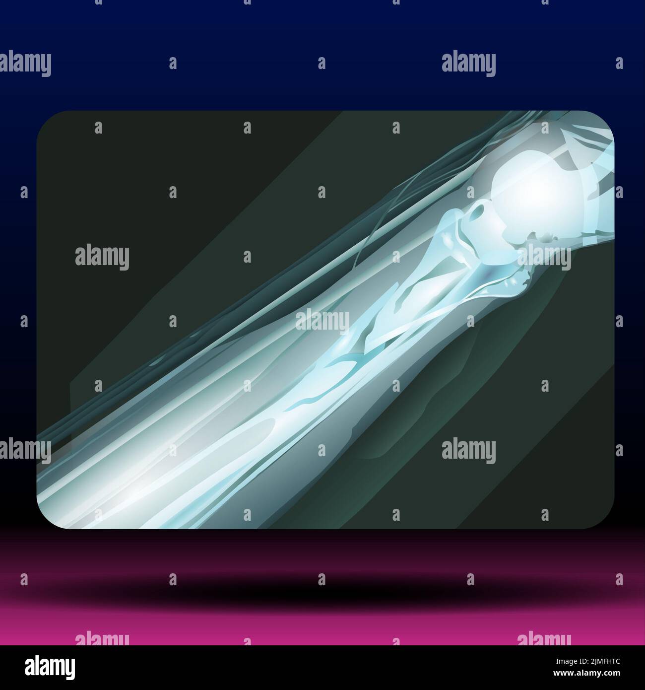 Fractura de pelvis -Fotos und -Bildmaterial in hoher Auflösung – Alamy