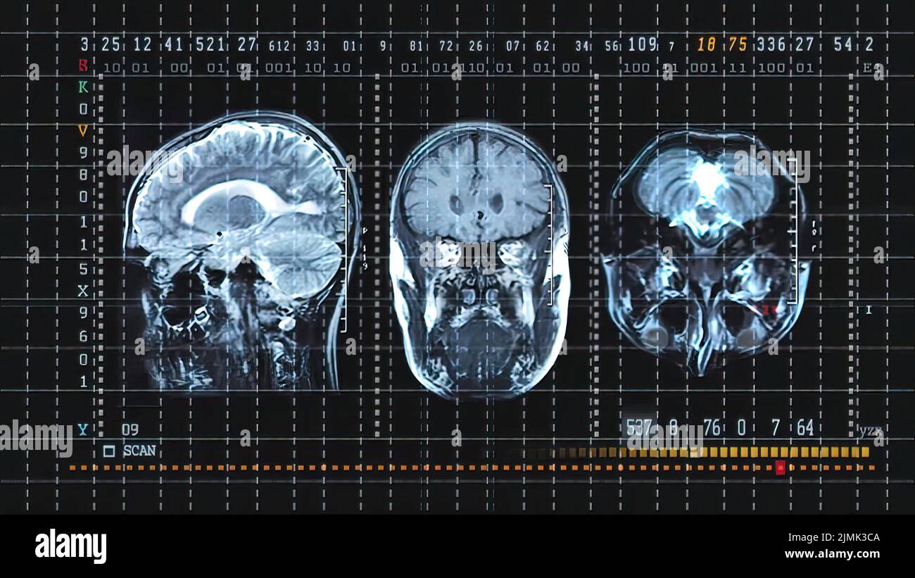 Mri brain scan -Fotos und -Bildmaterial in hoher Auflösung – Alamy