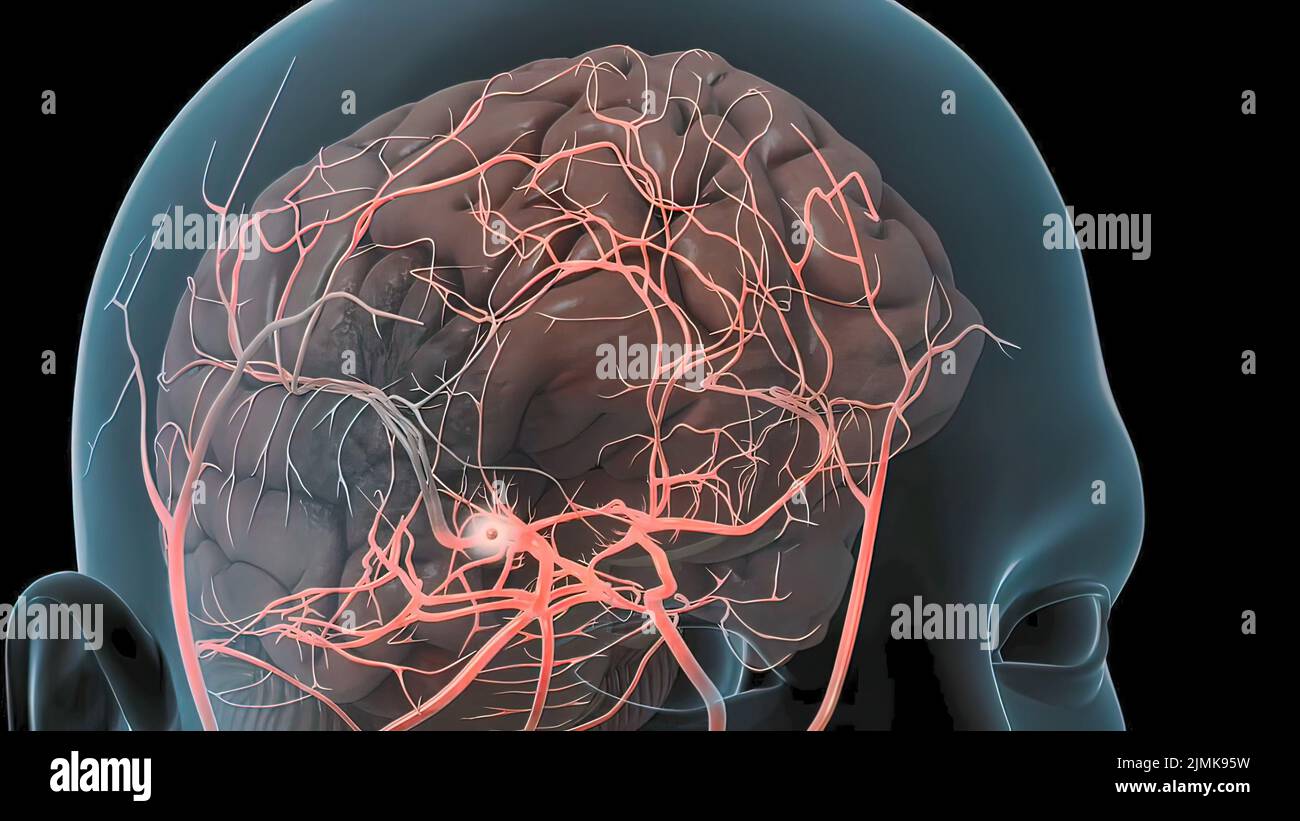 Arteria cerebri aneurysma -Fotos und -Bildmaterial in hoher Auflösung ...
