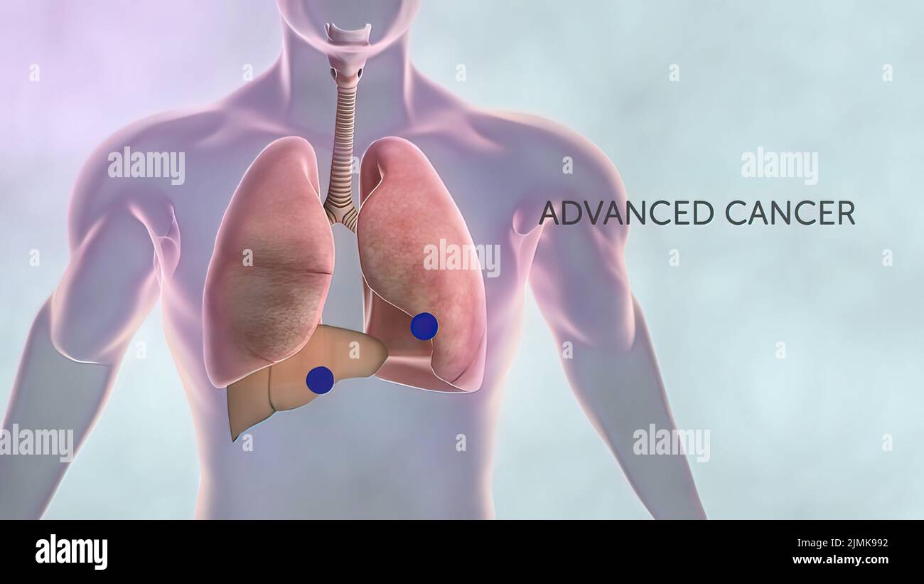Krebs im Frühstadium und in fortgeschrittenen Stadien der ...