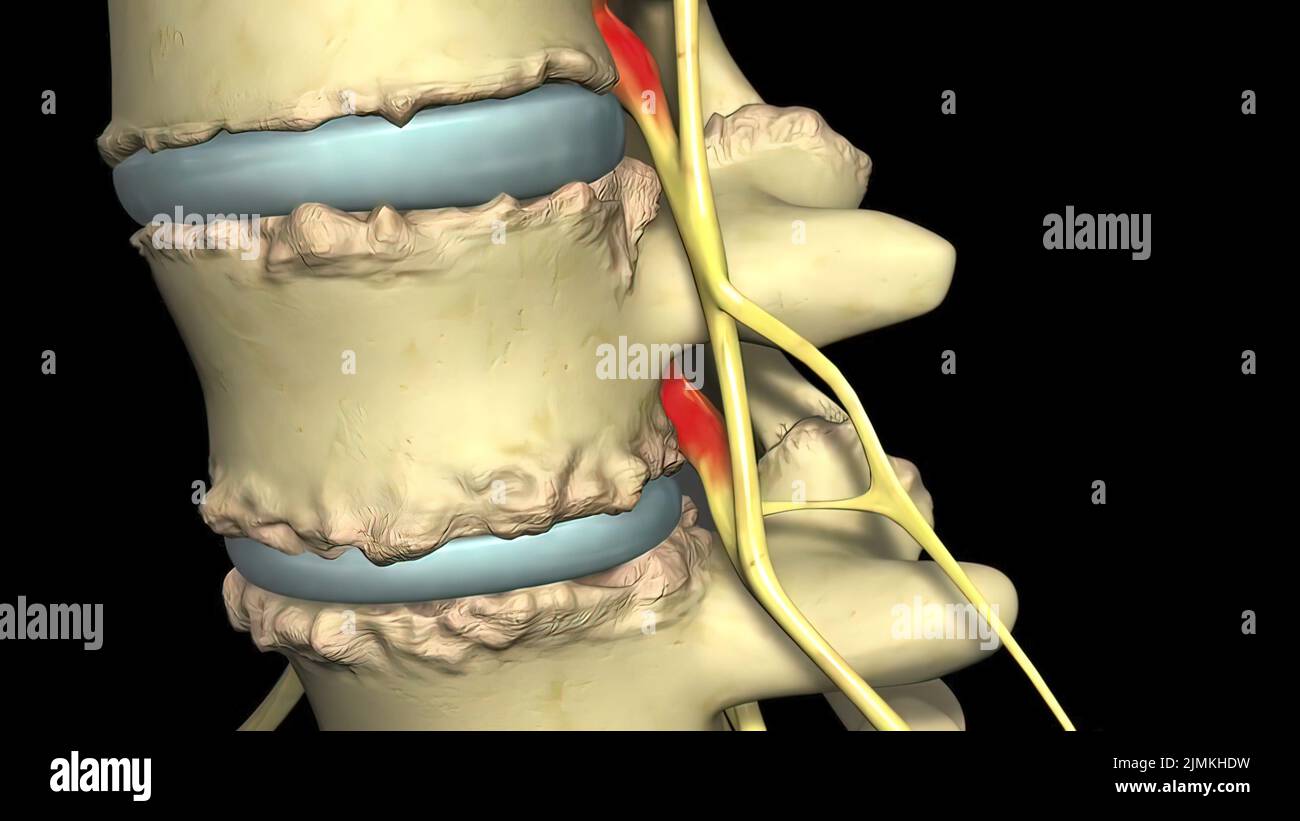 Spinal stenosis -Fotos und -Bildmaterial in hoher Auflösung – Alamy