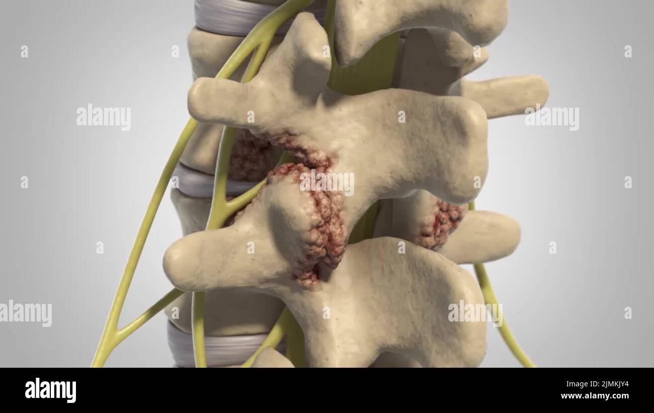 Degenerative disease -Fotos und -Bildmaterial in hoher Auflösung – Alamy