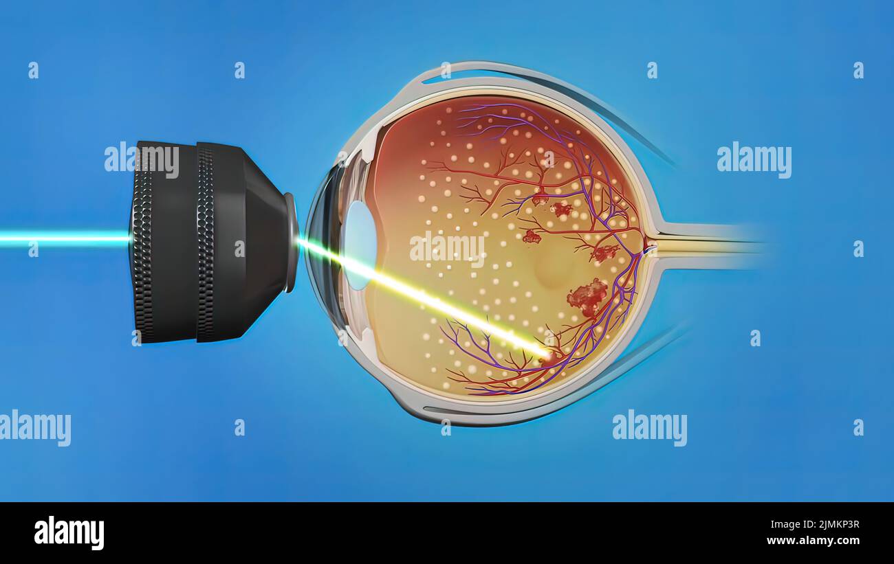 Ophthalmology laser -Fotos und -Bildmaterial in hoher Auflösung – Alamy
