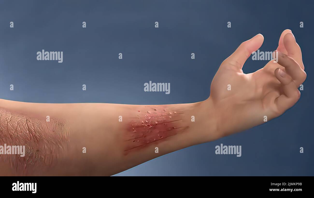 Burn scar -Fotos und -Bildmaterial in hoher Auflösung – Alamy