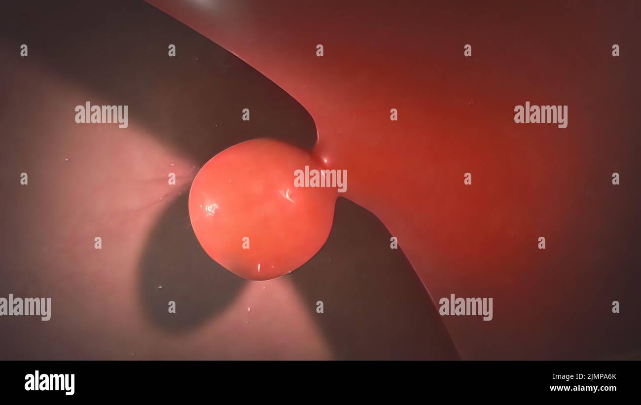 Arteria cerebri aneurysma -Fotos und -Bildmaterial in hoher Auflösung ...