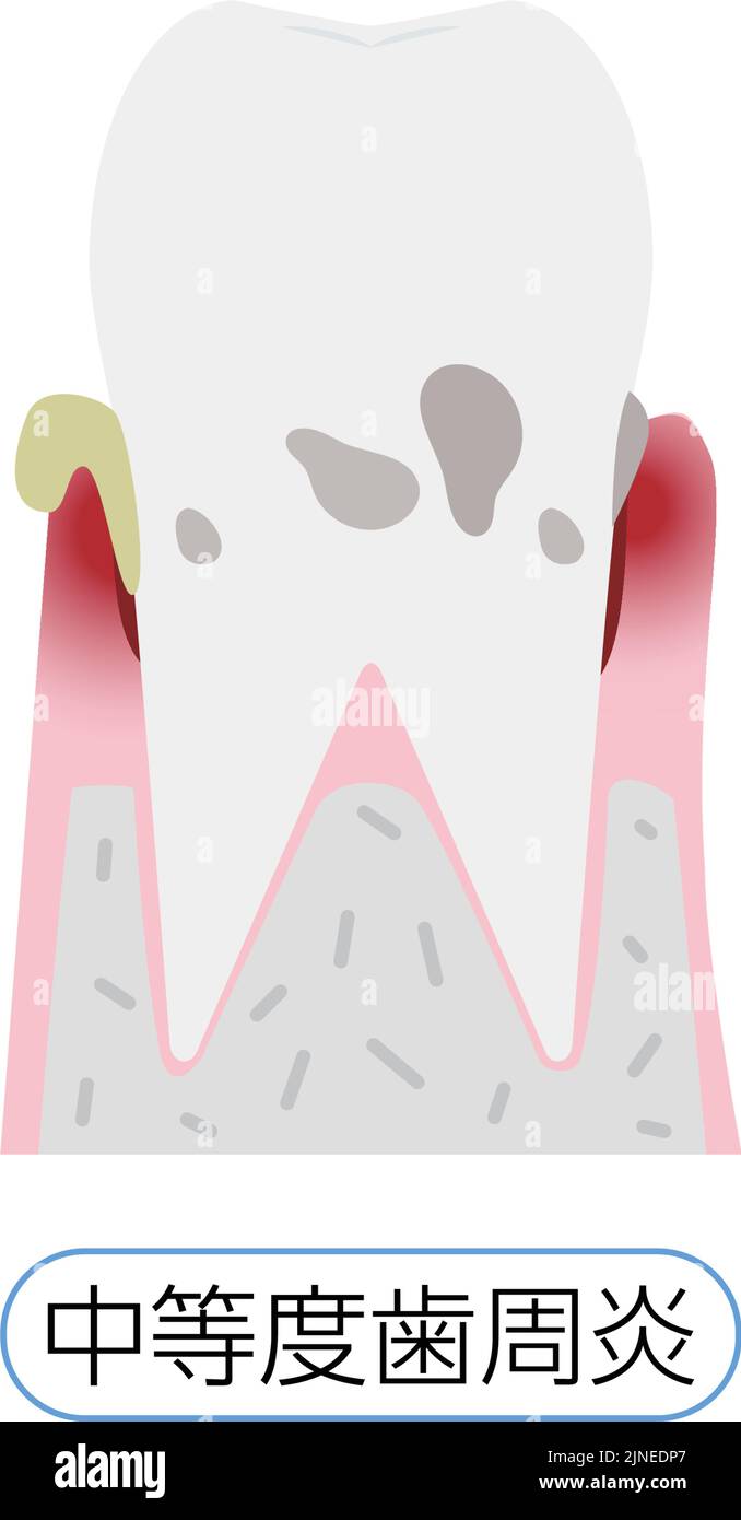 Illustration nach Stadium der Parodontitis: Moderate Parodontitis ...